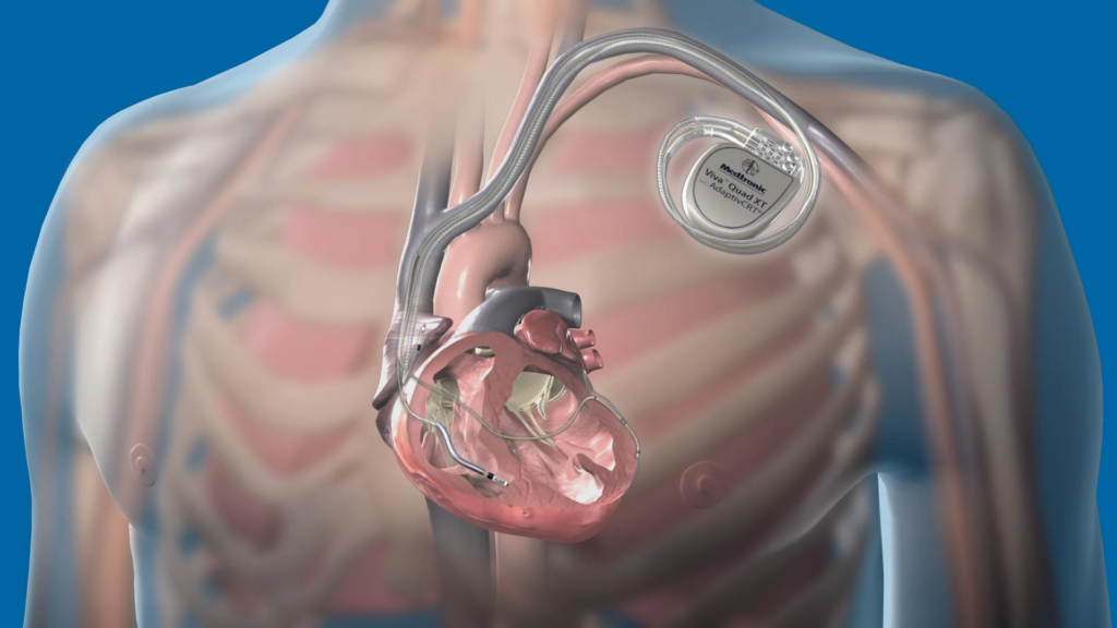 CRT-P & CRT-D Implantation - Hrudayam Heart & Woman Care Clinic