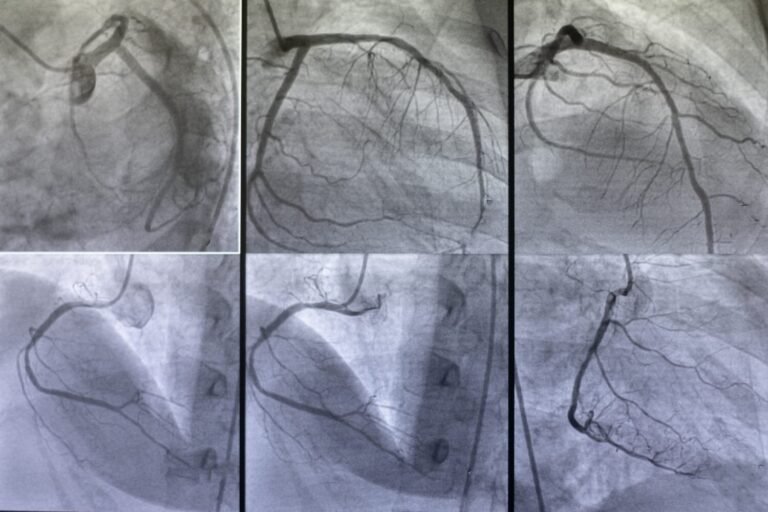 Coronary Angiography - Hrudayam Heart & Woman Care Clinic